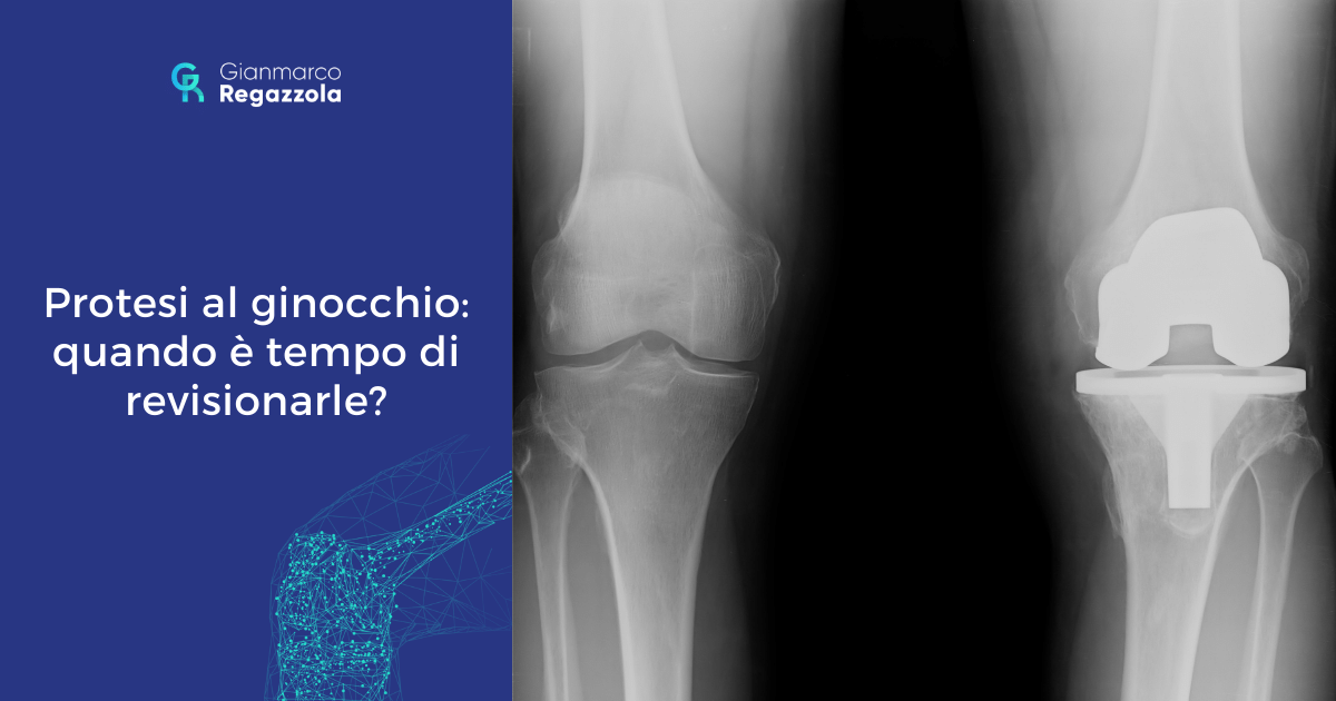 Protesi al ginocchio: quando è tempo di revisionarla? - Dr. Gianmarco ...