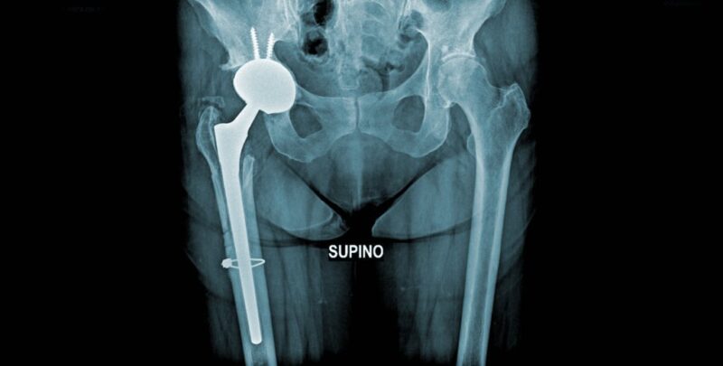 Revisione della protesi di anca - Dr. Gianmarco Regazzola